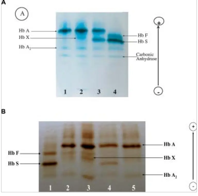 Cellulose Acetate Electrophoresis Principle And Application Microbe Online